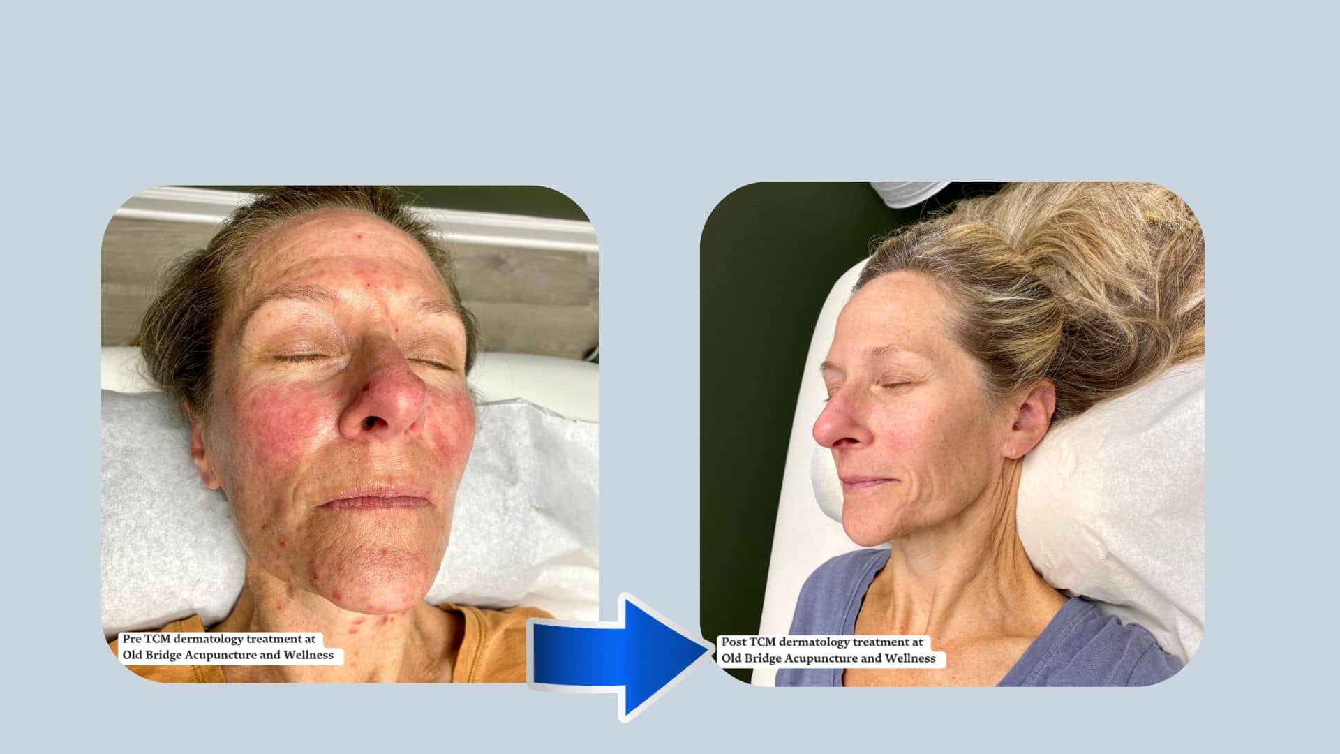 Our Patient's Remarkable Acne and Rosacea Recovery - She Got Her Face ...